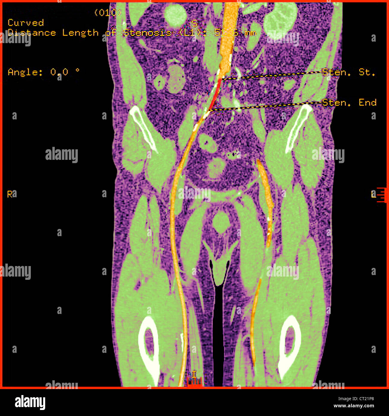 Stenosi dell'aorta addominale immagini e fotografie stock ad alta risoluzione - Alamy