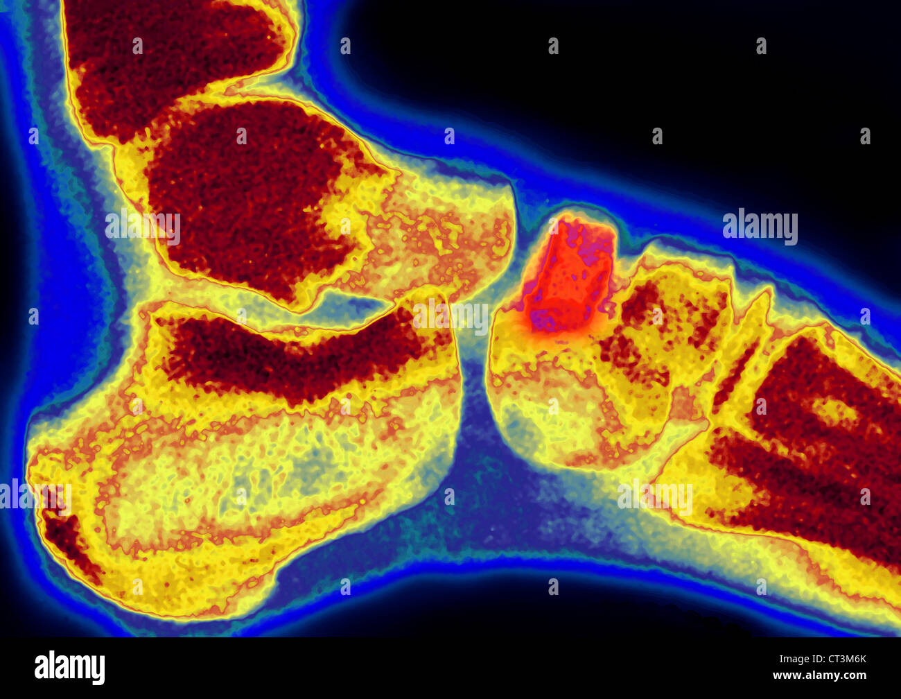 Tarsal bones immagini e fotografie stock ad alta risoluzione - Alamy