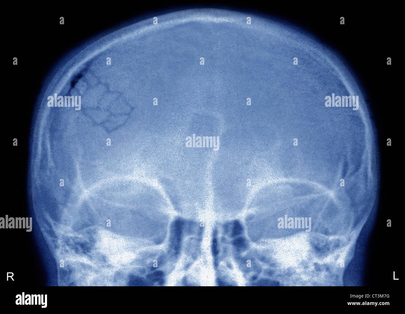 Cranio x ray immagini e fotografie stock ad alta risoluzione - Alamy