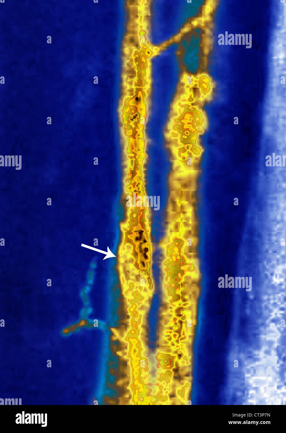 Venas peroneas immagini e fotografie stock ad alta risoluzione - Alamy