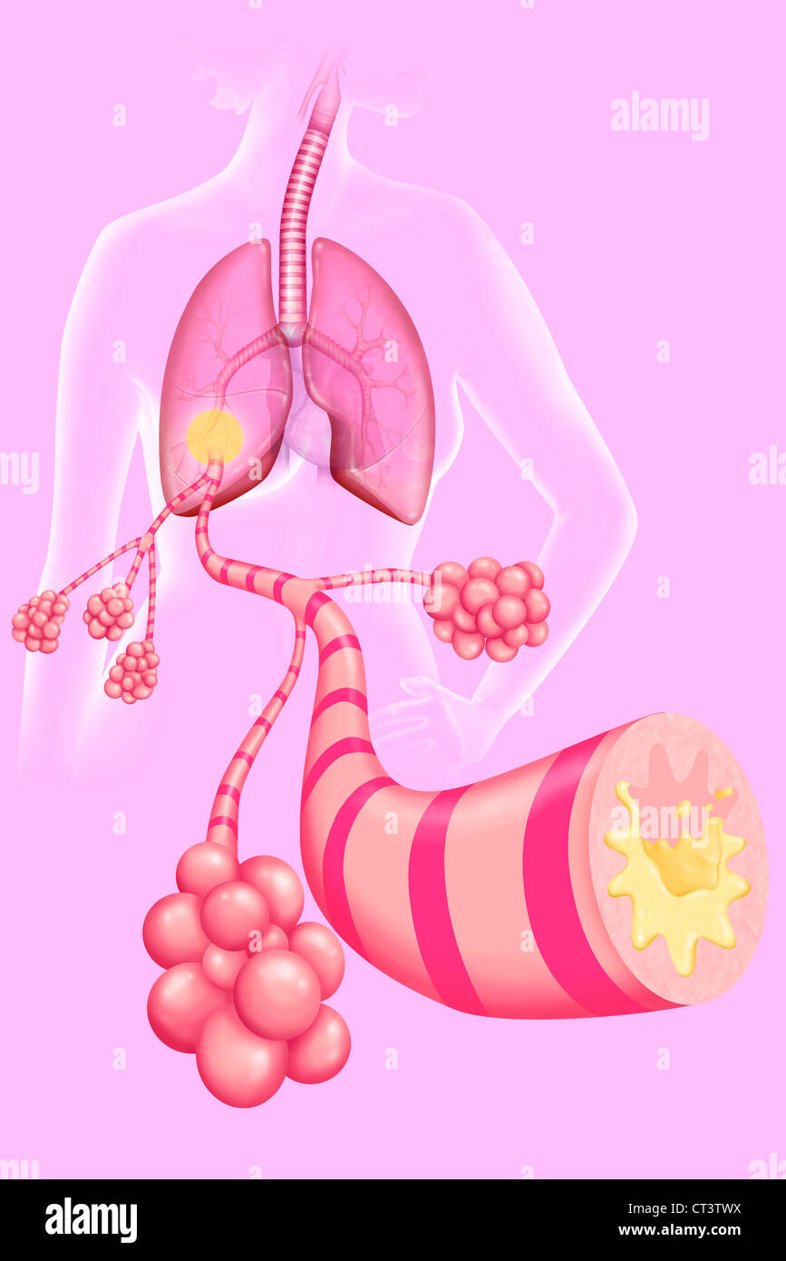 Bronchitis drawing immagini e fotografie stock ad alta risoluzione - Alamy