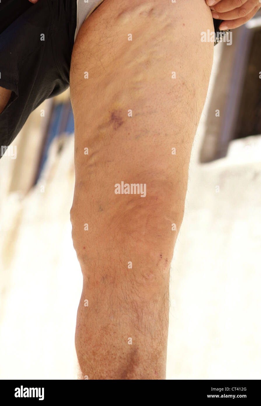 Vene gambe coscia immagini e fotografie stock ad alta risoluzione - Alamy