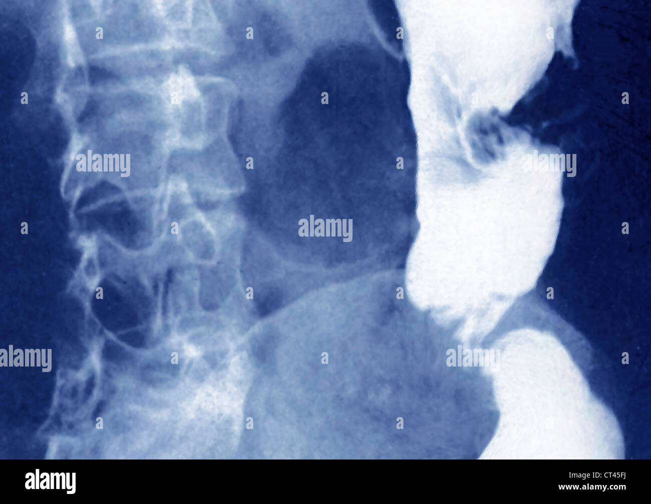 Colon sinistro immagini e fotografie stock ad alta risoluzione - Alamy