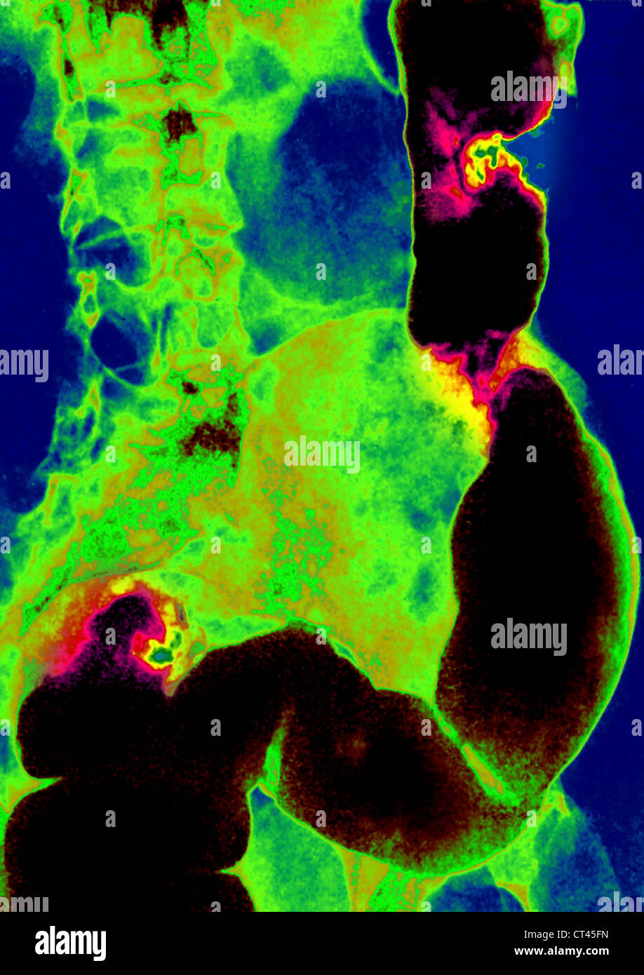 Colon sinistro immagini e fotografie stock ad alta risoluzione - Alamy