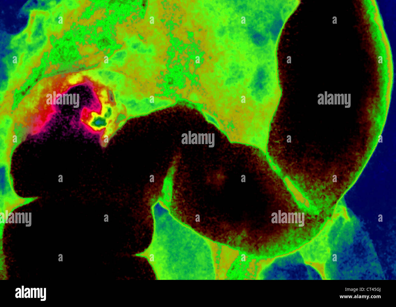 Colon sinistro immagini e fotografie stock ad alta risoluzione - Alamy