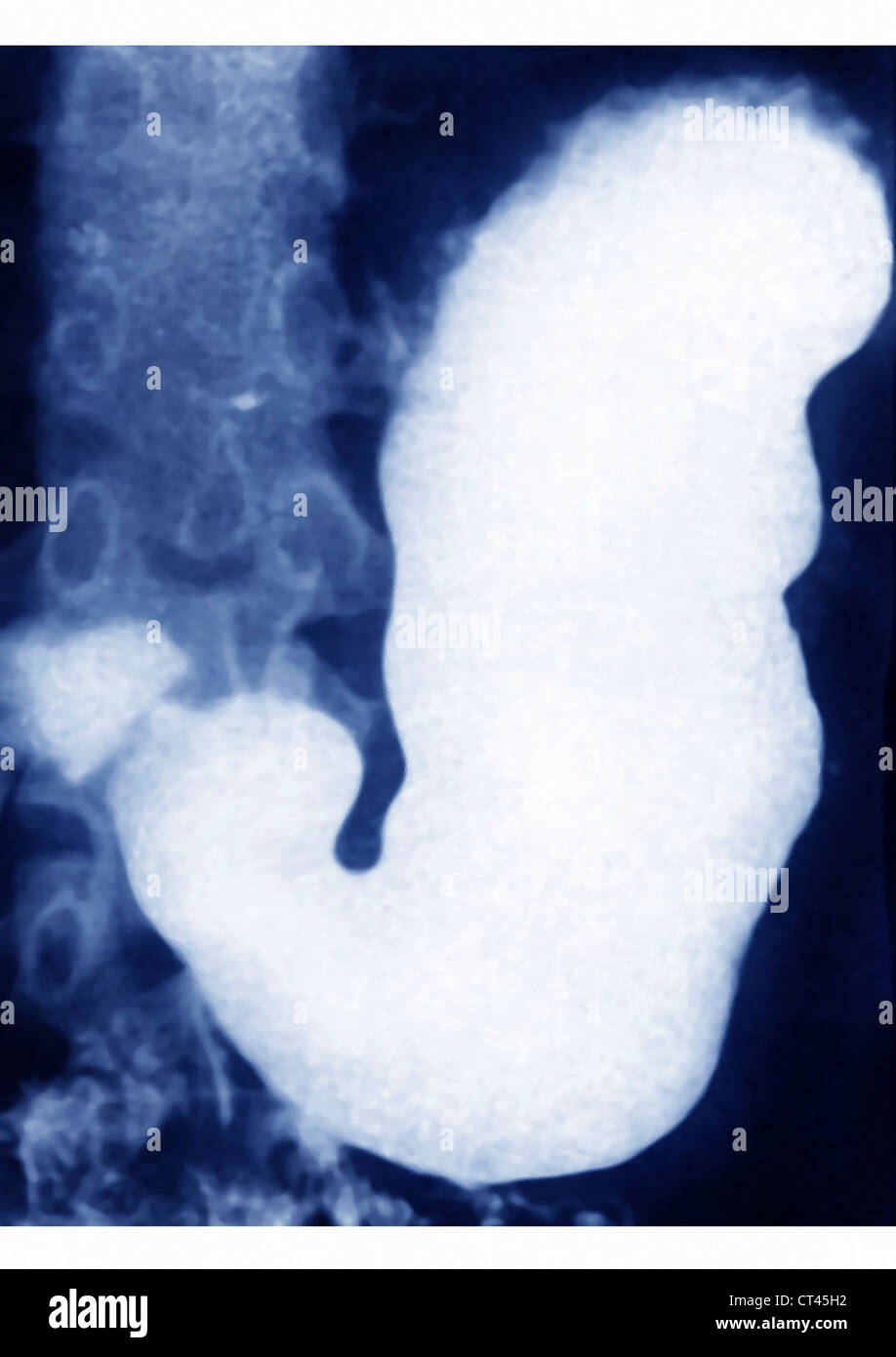 Sfintere pilorico immagini e fotografie stock ad alta risoluzione - Alamy