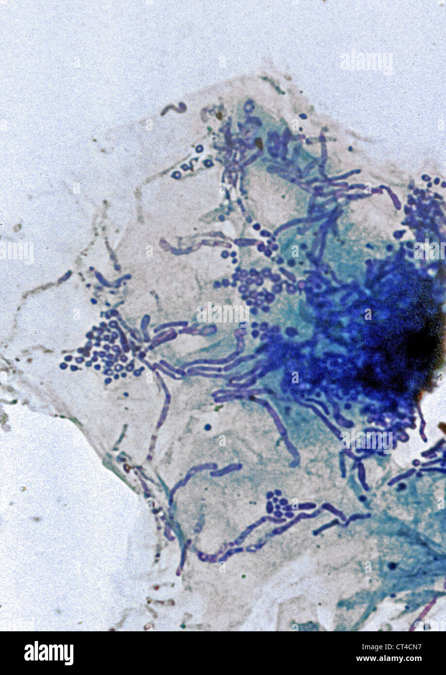 Pitiriasi versicolor immagini e fotografie stock ad alta risoluzione ...
