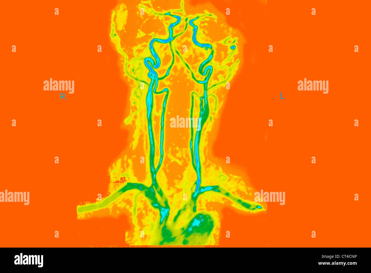 Arteria carotide esterna immagini e fotografie stock ad alta ...