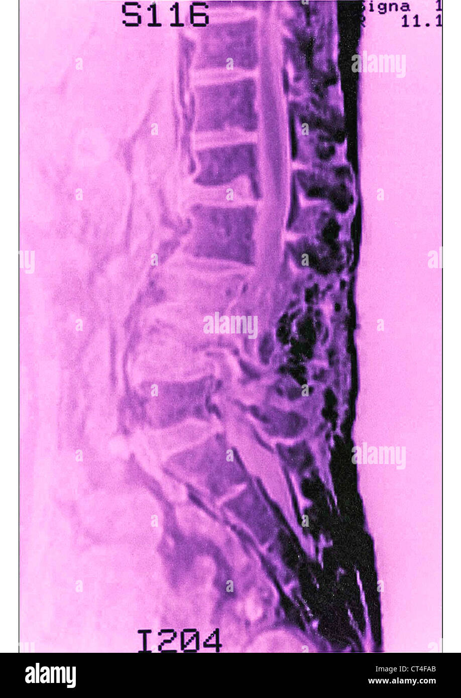 Mri di frattura da compressione lombare immagini e fotografie stock ad ...