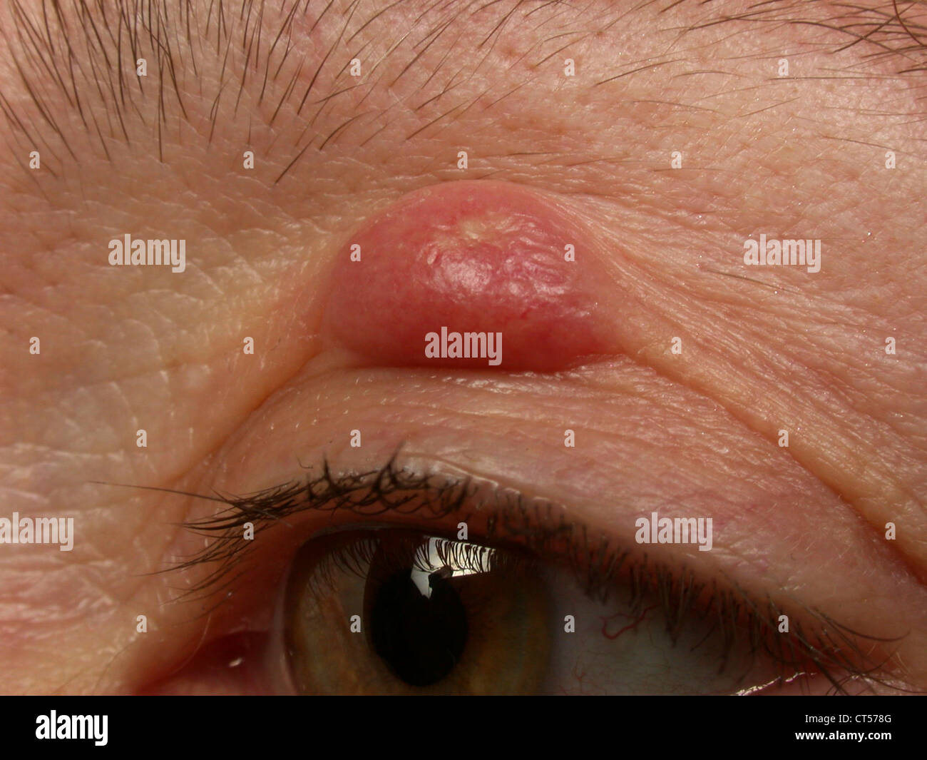 Eyelid cyst immagini e fotografie stock ad alta risoluzione - Alamy