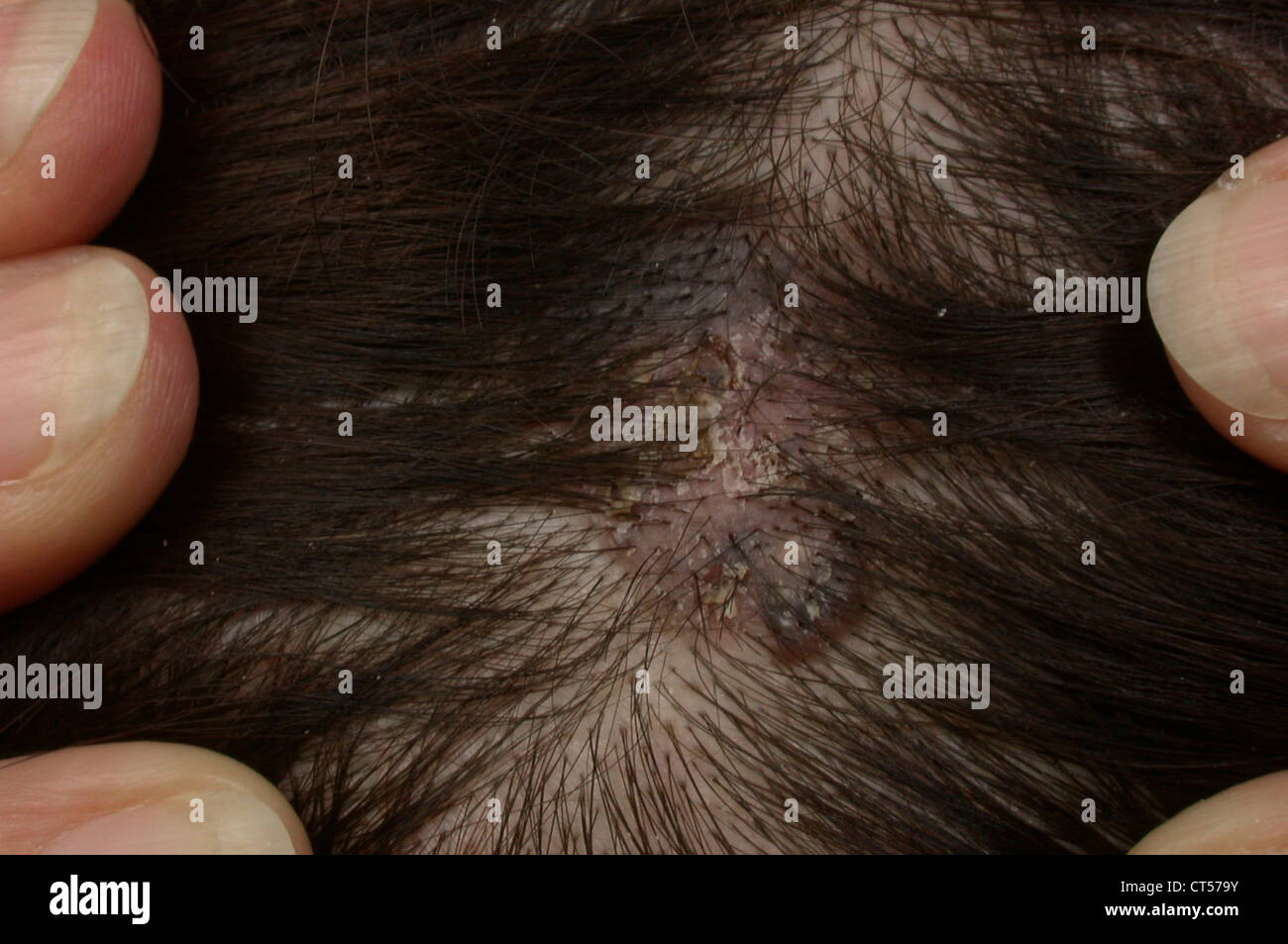 Carcinoma delle cellule basali immagini e fotografie stock ad alta ...