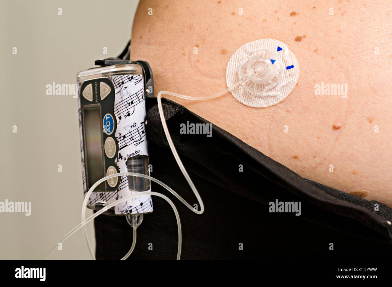 Pompa Per Infusione Ambulatoriale Esterna Di Insulina