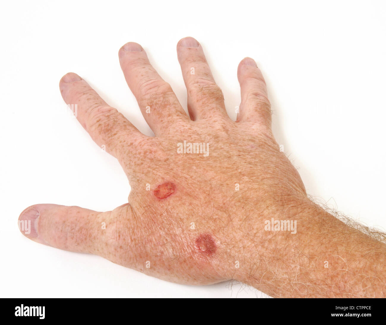 Lesioni cutanee immagini e fotografie stock ad alta risoluzione - Alamy