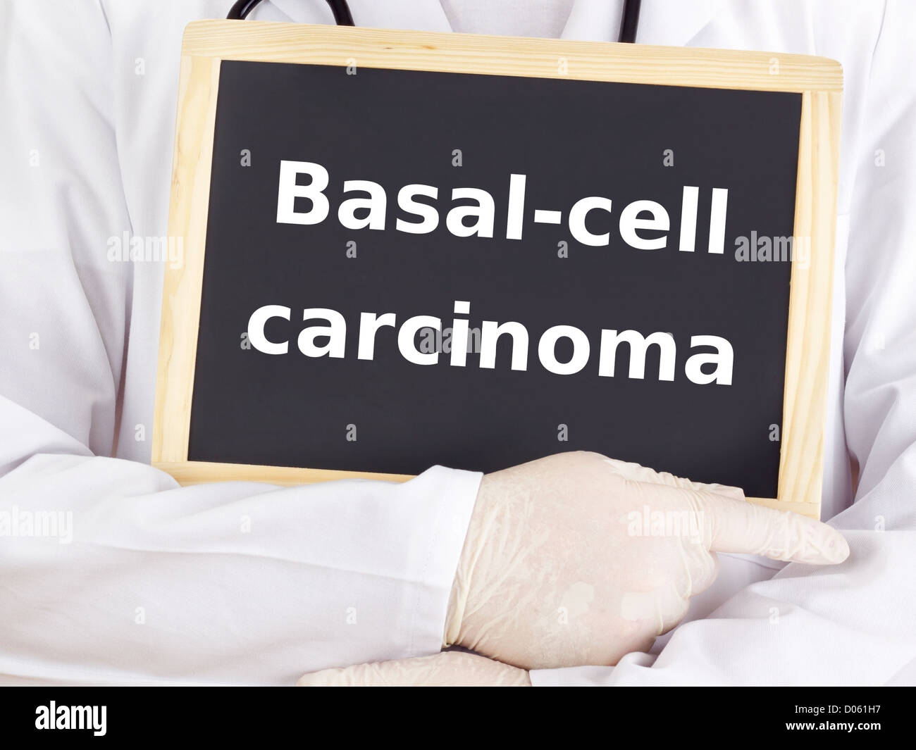 Carcinoma delle cellule basali immagini e fotografie stock ad alta ...
