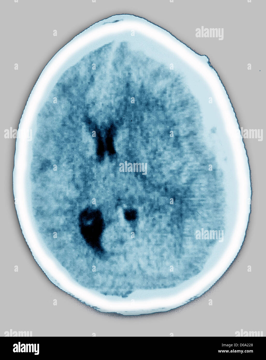 Hematoma subdural immagini e fotografie stock ad alta risoluzione - Alamy