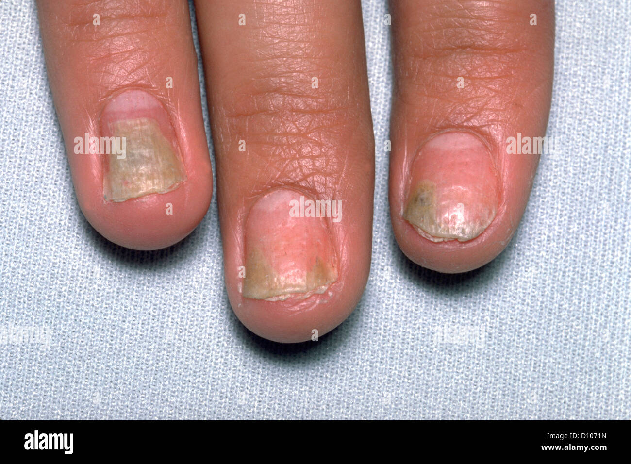 Psoriasis nails immagini e fotografie stock ad alta risoluzione - Alamy