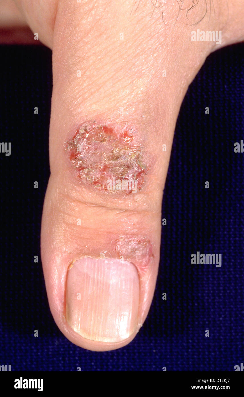 Nummular eczema dermatology skin immagini e fotografie stock ad alta ...