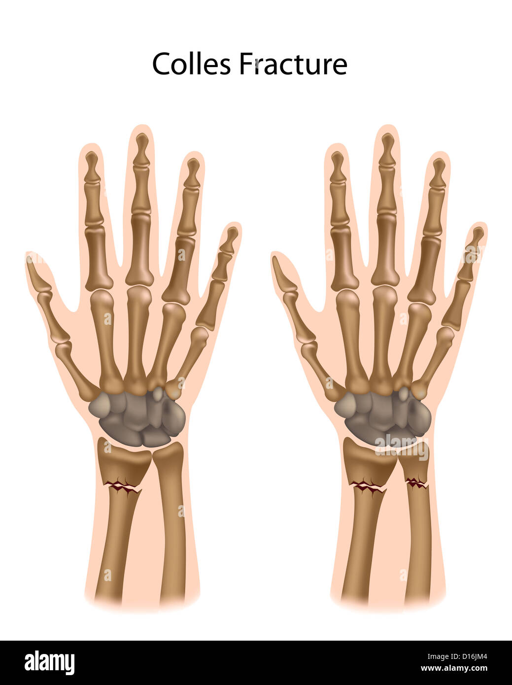Colles fracture immagini e fotografie stock ad alta risoluzione - Alamy