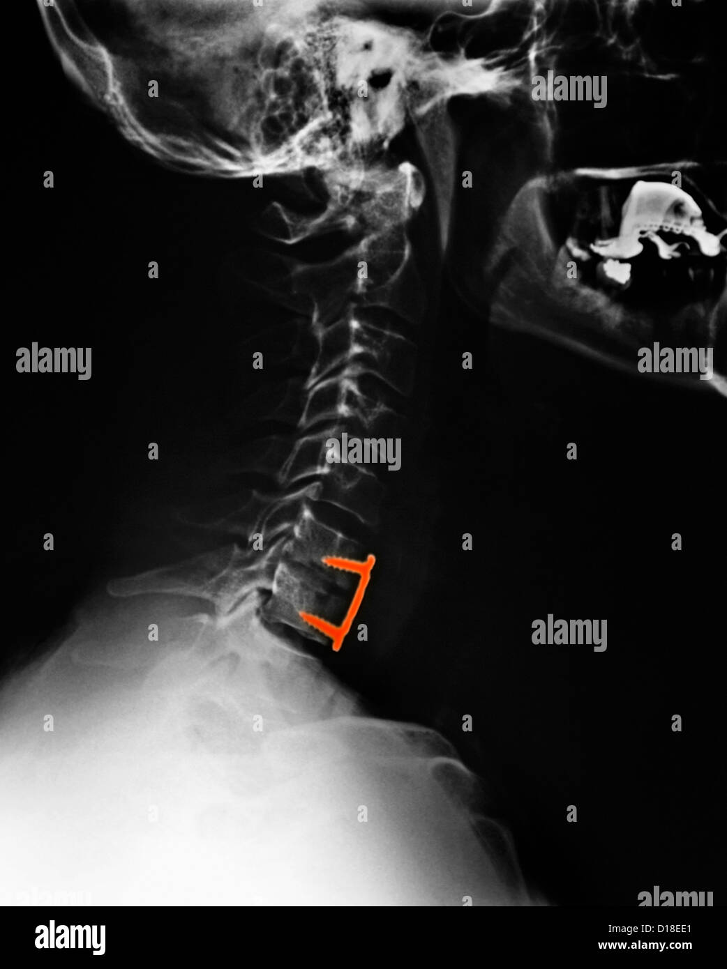 Radiografia del collo delle vertebre cervicali immagini e fotografie ...