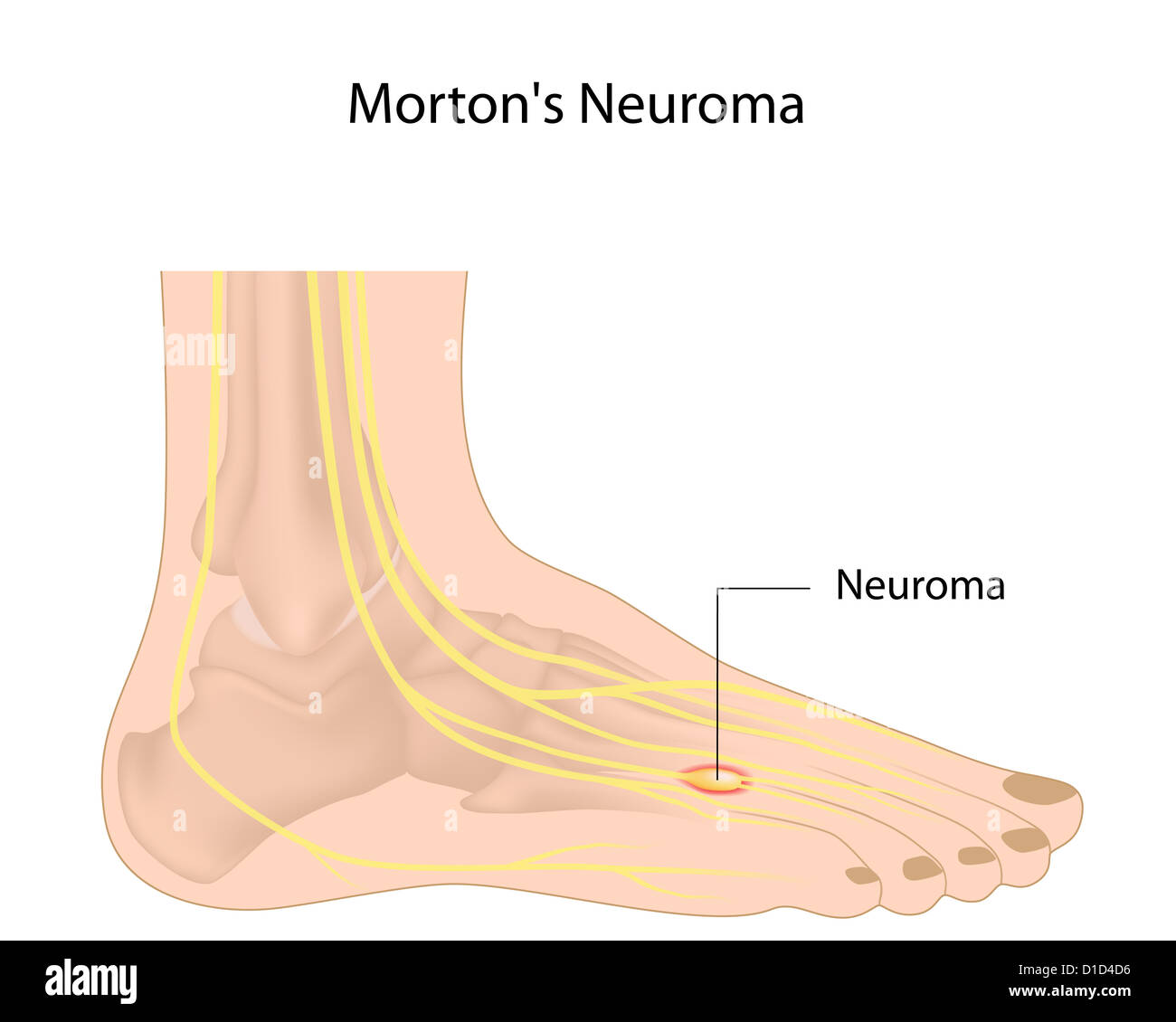 Neuroma di mortons immagini e fotografie stock ad alta risoluzione - Alamy