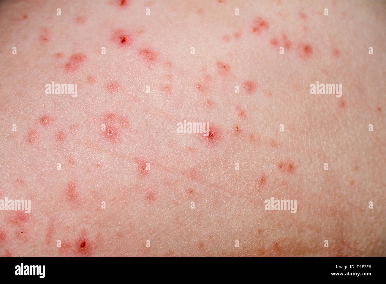 Puntini Rossi Su Eruzione Cutanea