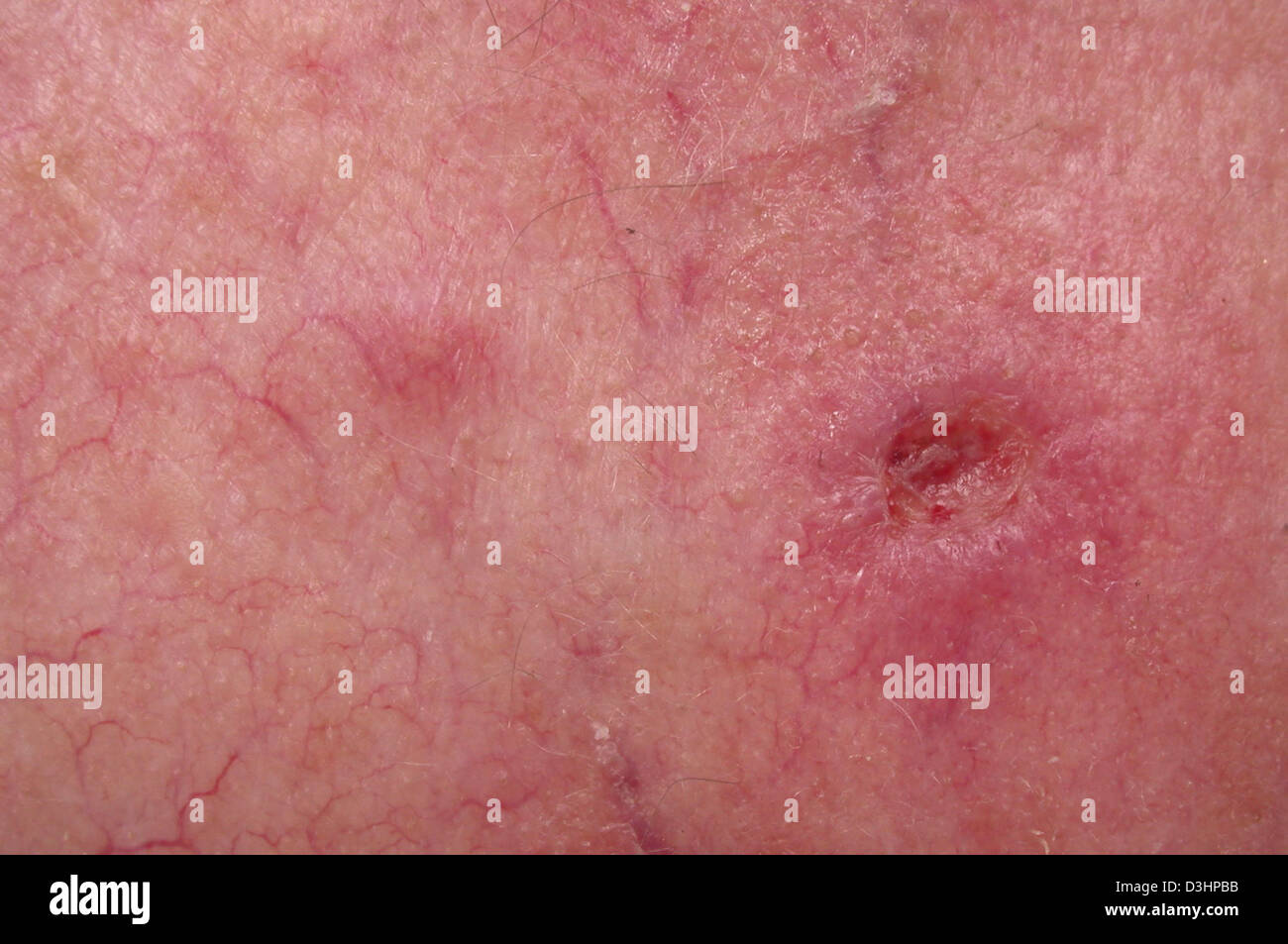 Basal cell carcinoma bcc immagini e fotografie stock ad alta ...