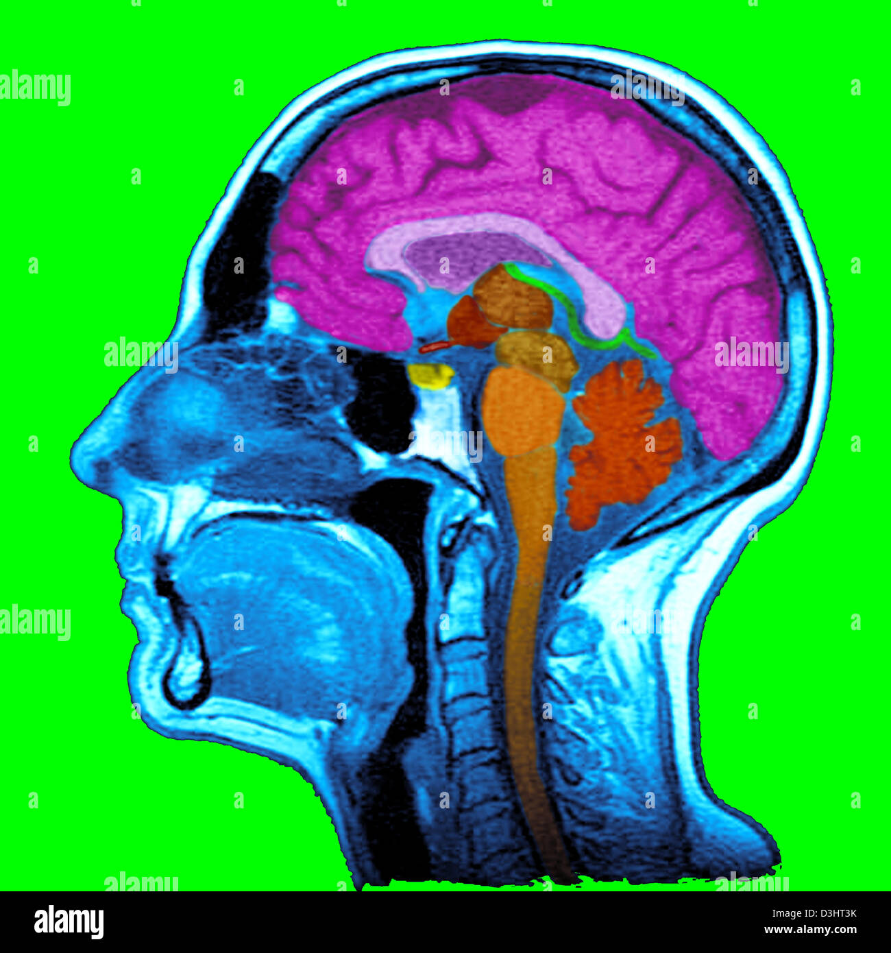 Vene cerebrali immagini e fotografie stock ad alta risoluzione - Alamy