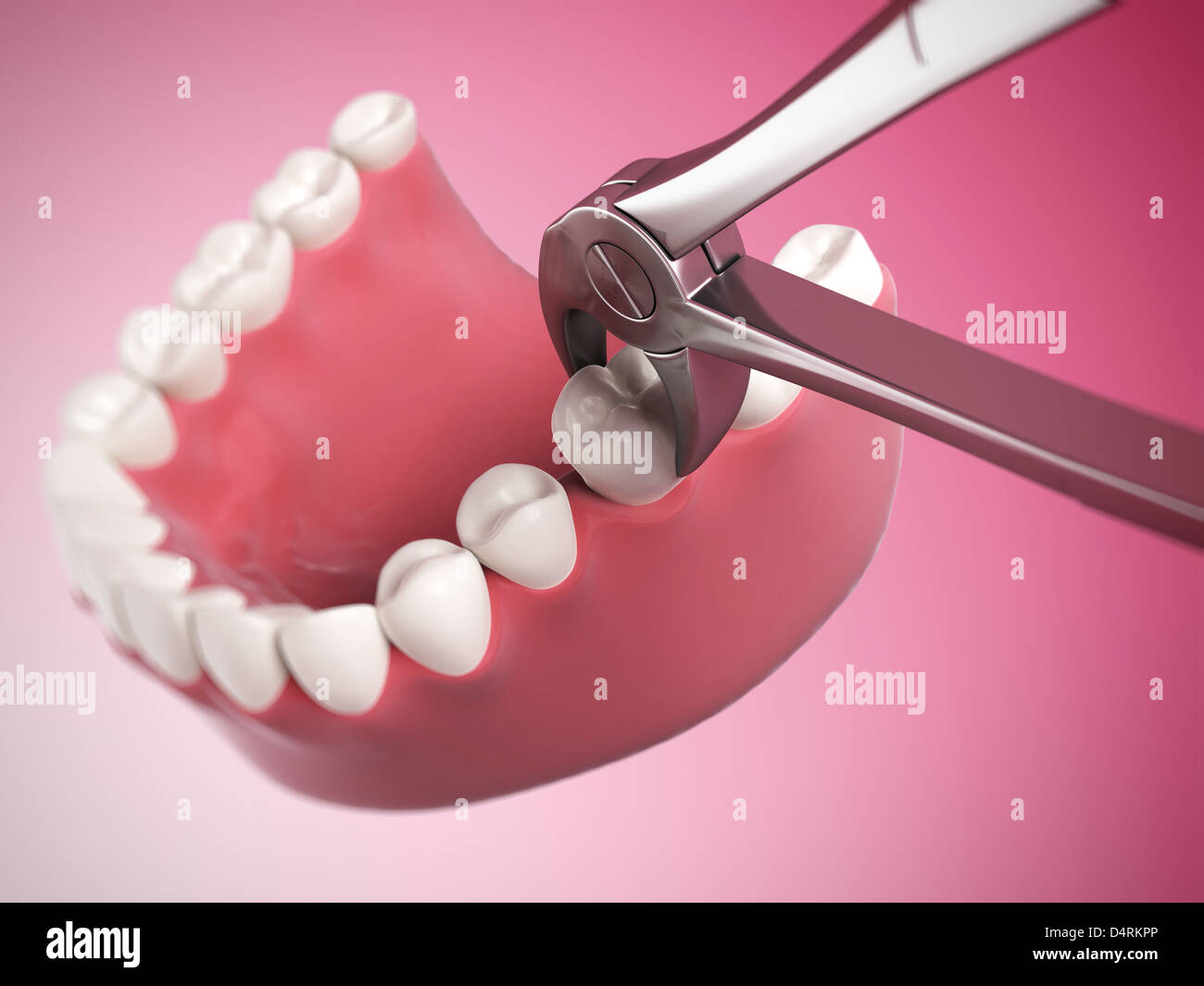 Estrazione dente immagini e fotografie stock ad alta risoluzione - Alamy