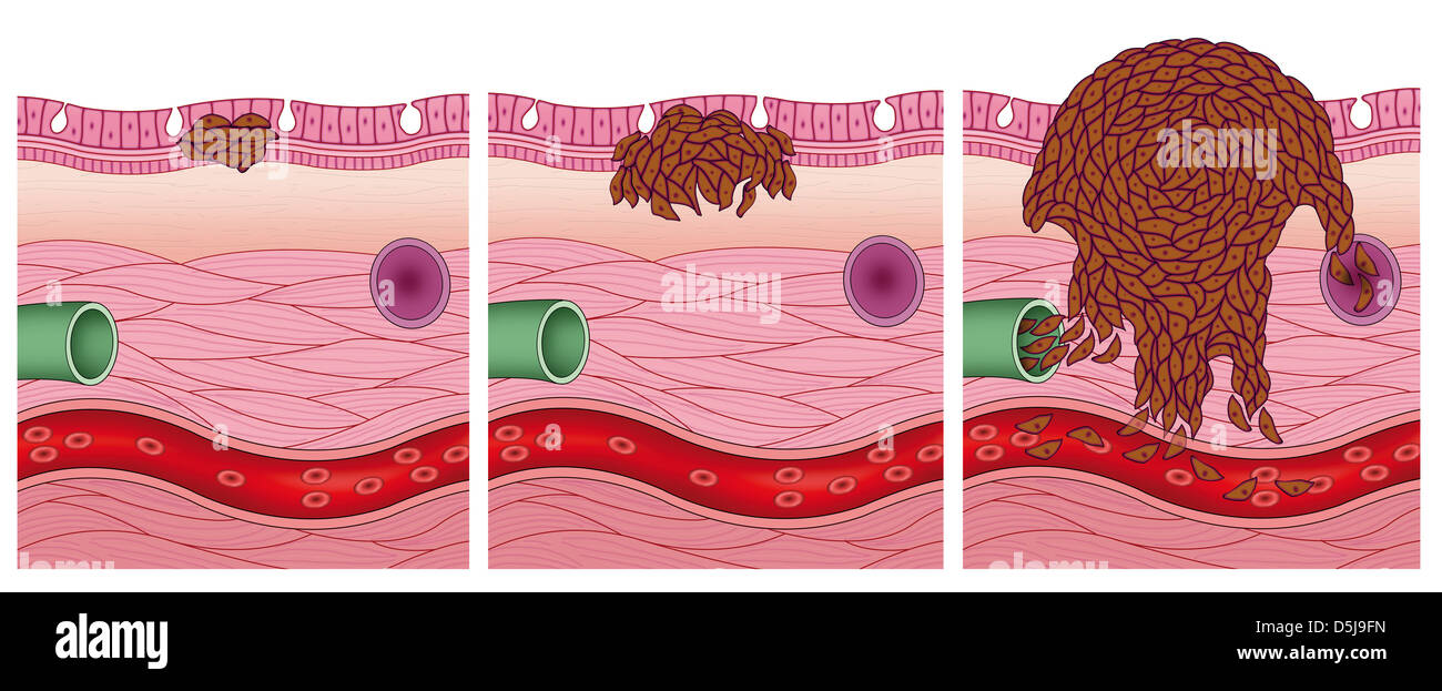Tumore e ulcera del cancro delle cellule epiteliali immagini e ...