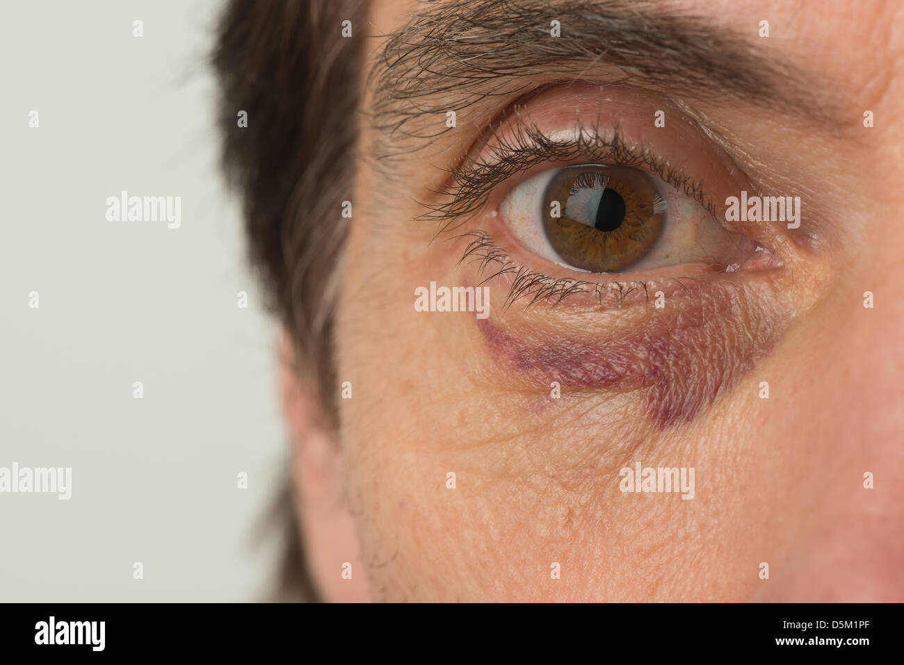 Infiammazione o gonfiore della borsa sotto gli occhi immagini e ...