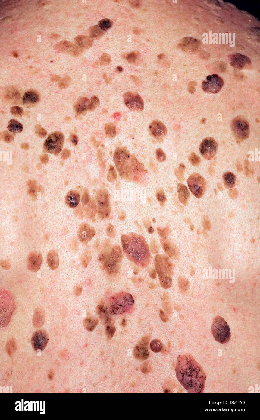 Verruche seborroiche immagini e fotografie stock ad alta risoluzione ...