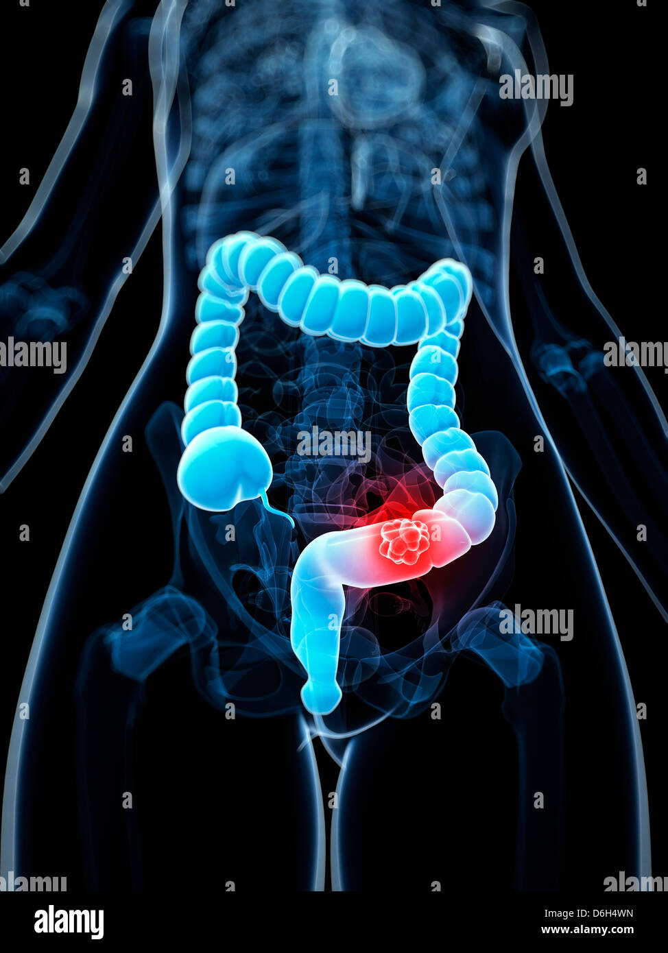 Cancro al colon immagini e fotografie stock ad alta risoluzione - Alamy