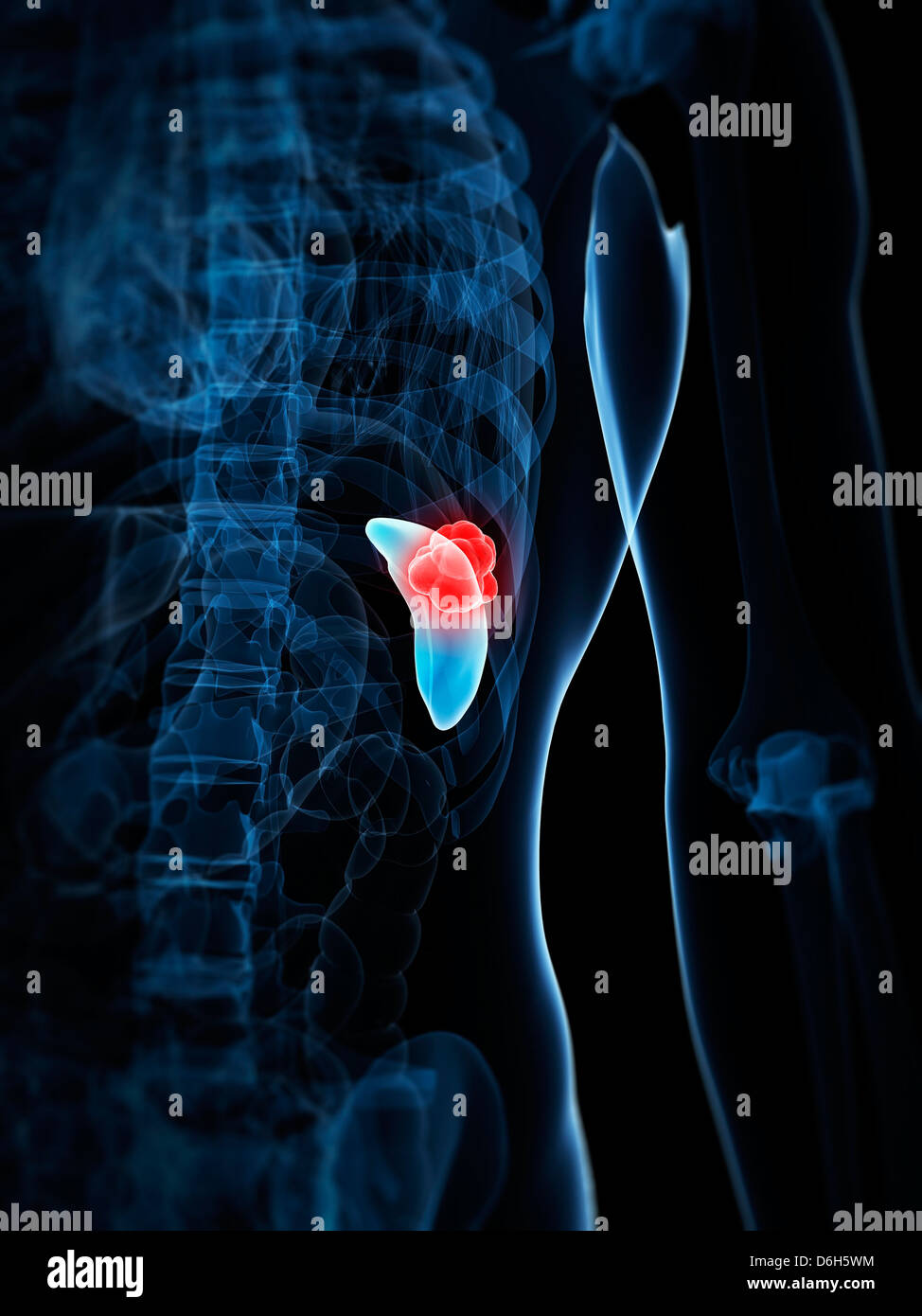 Carcinoma surrenalico immagini e fotografie stock ad alta risoluzione ...