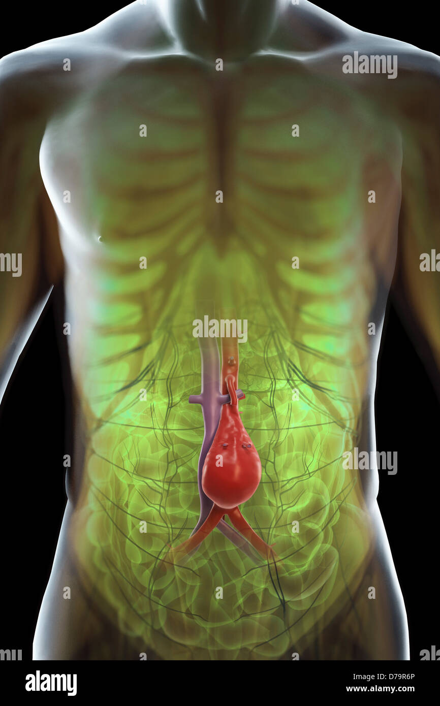 Aorta addominale immagini e fotografie stock ad alta risoluzione - Alamy