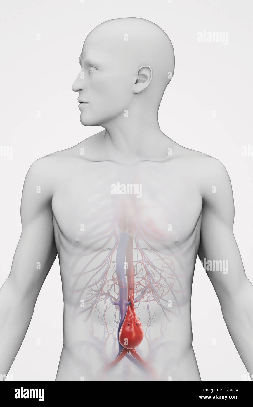 Aneurisma dell'aorta addominale immagini e fotografie stock ad alta risoluzione - Alamy