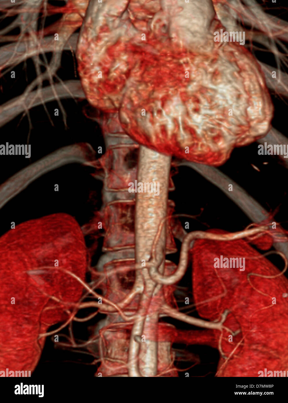 Abdominal aorta immagini e fotografie stock ad alta risoluzione - Alamy