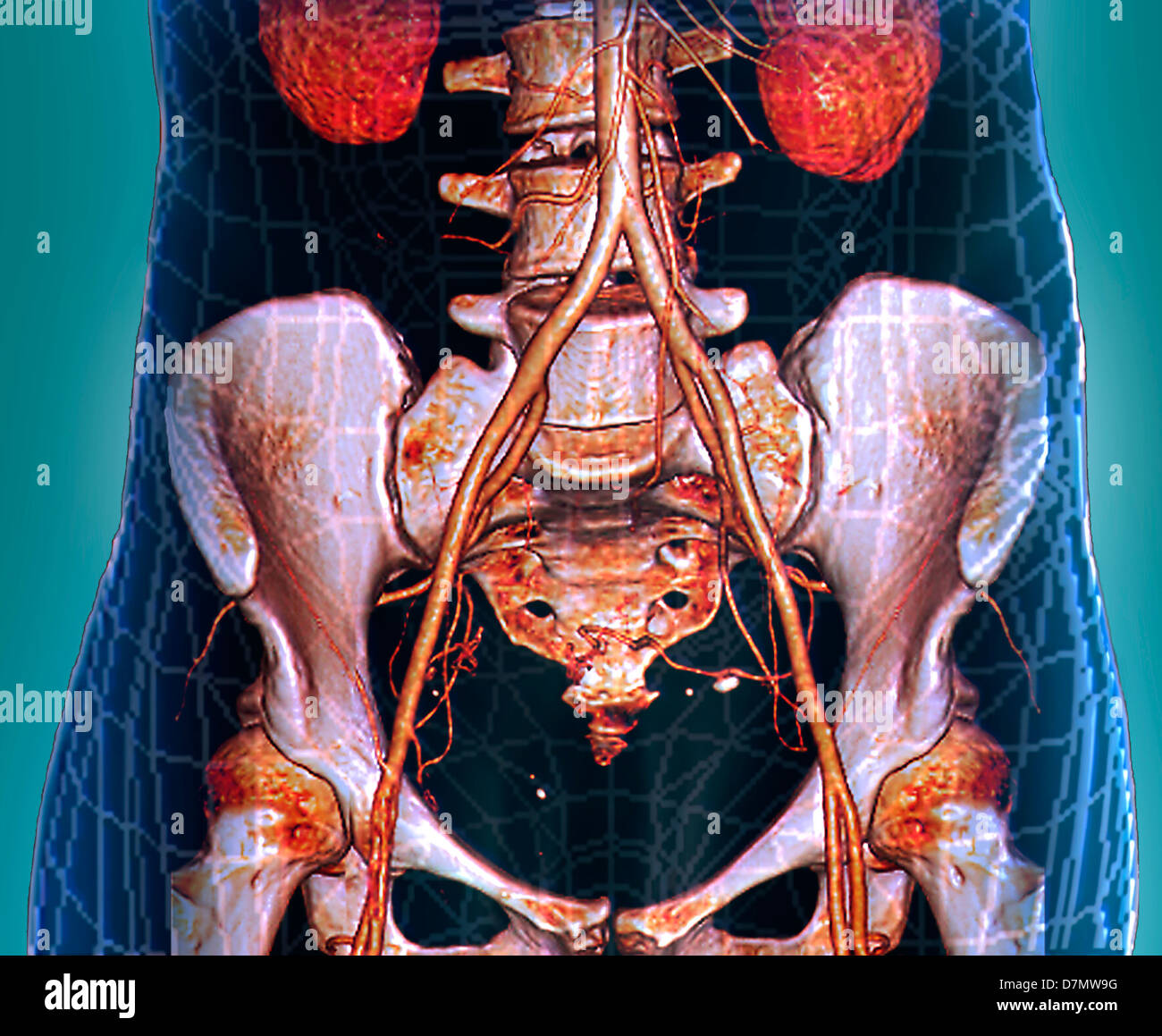 Aorta addominale, 3D CT scan Foto stock - Alamy