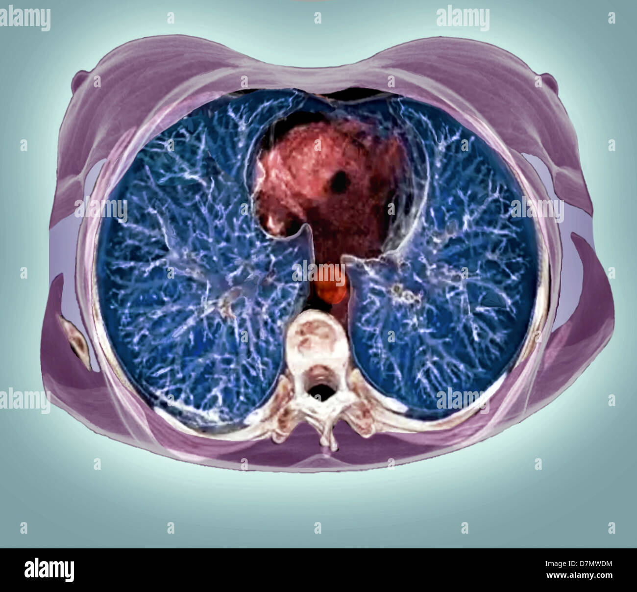 Anatomia del torace, 3D CT scan Foto stock - Alamy