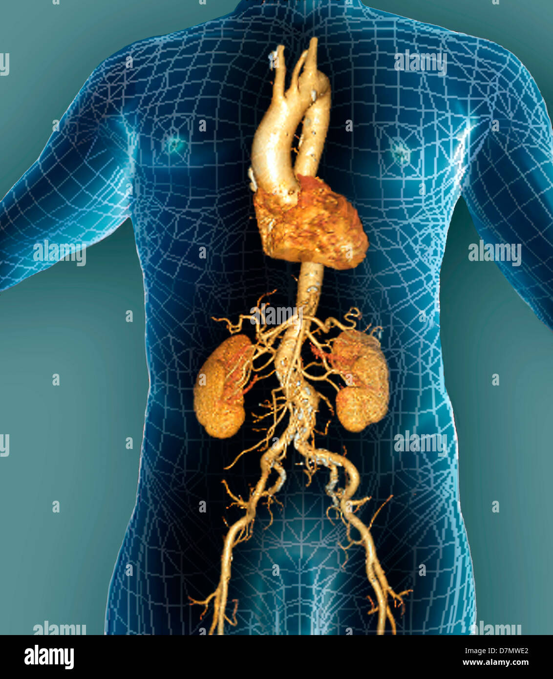 Angiogram of the abdominal aorta immagini e fotografie stock ad alta ...