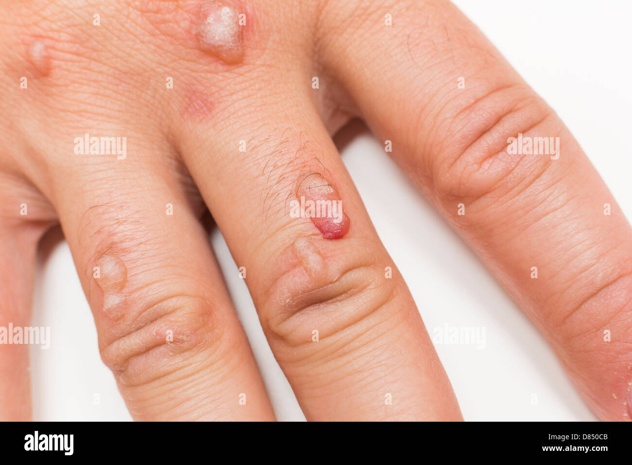 Verruca coperto immagini e fotografie stock ad alta risoluzione - Alamy