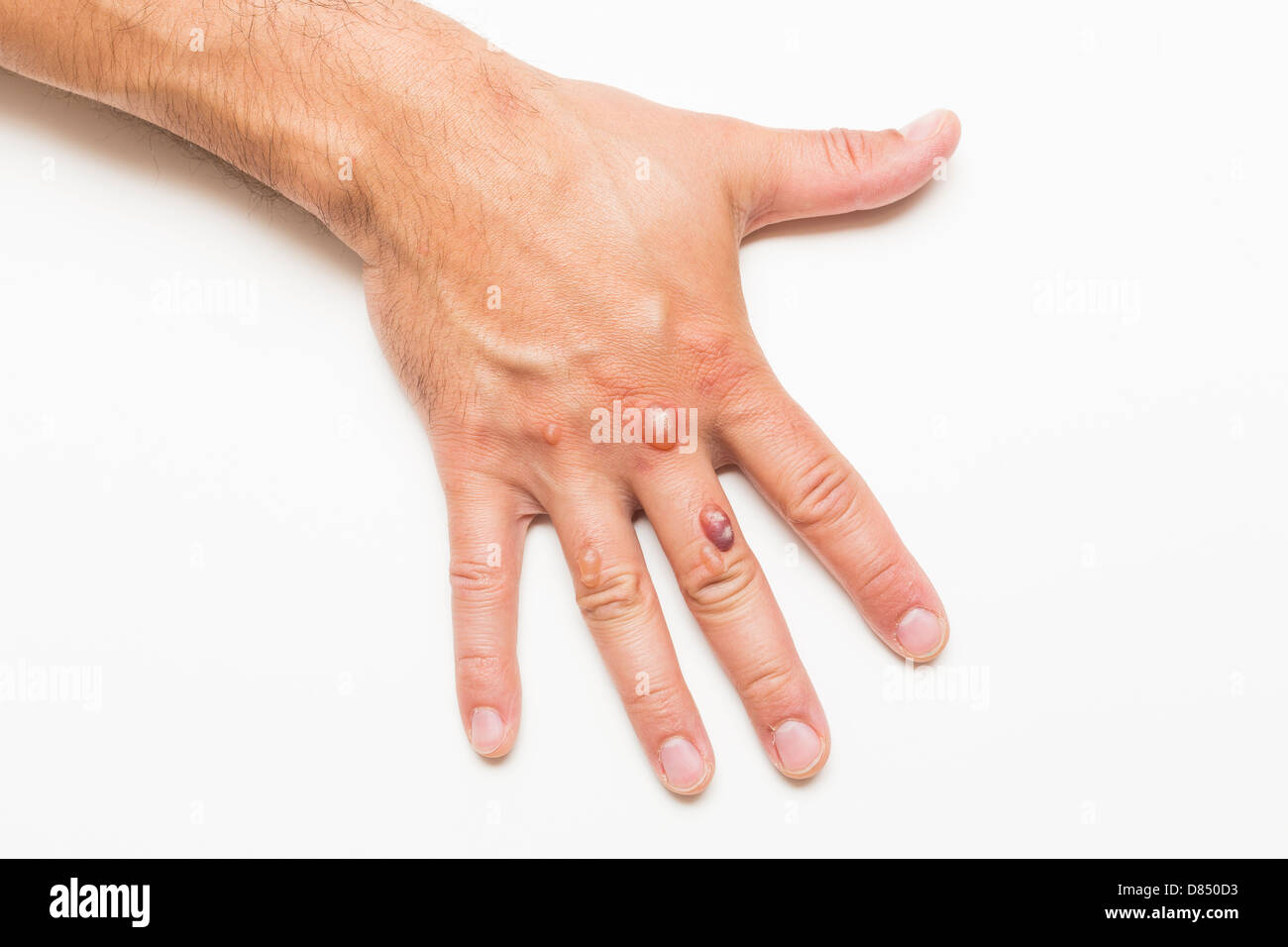 Verruca a mano immagini e fotografie stock ad alta risoluzione - Alamy