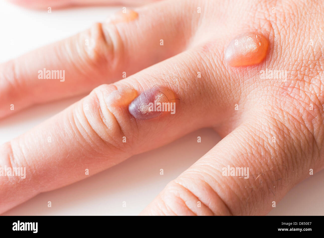 Verruca treatment immagini e fotografie stock ad alta risoluzione - Alamy