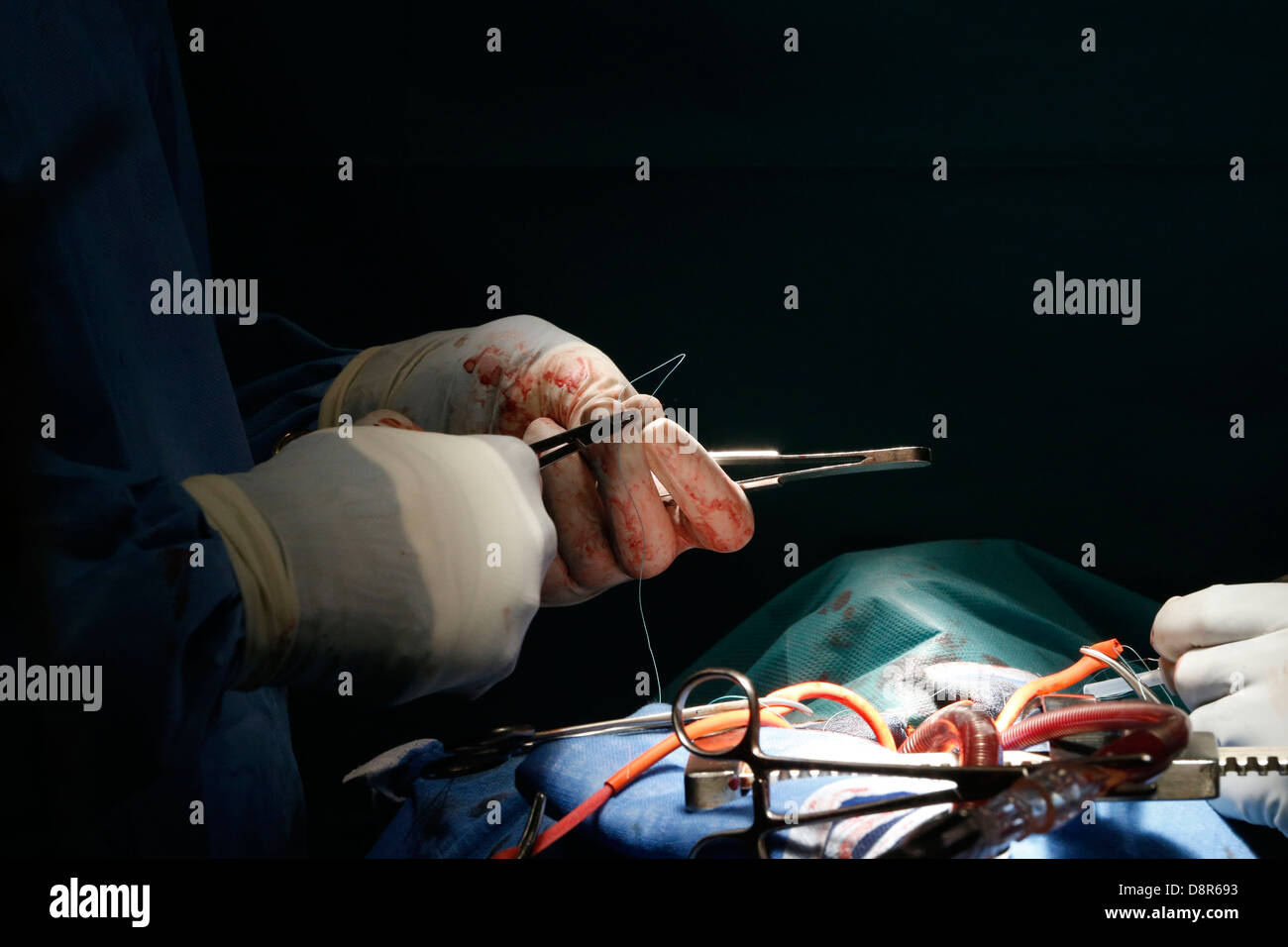 Intervento di bypass cardiaco immagini e fotografie stock ad alta ...