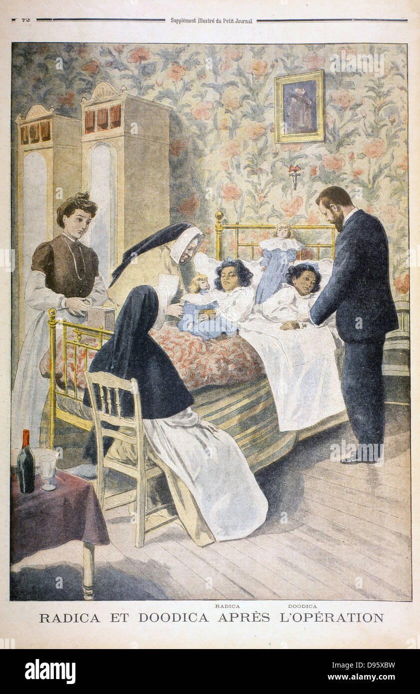 Conjoined twins separated immagini e fotografie stock ad alta ...