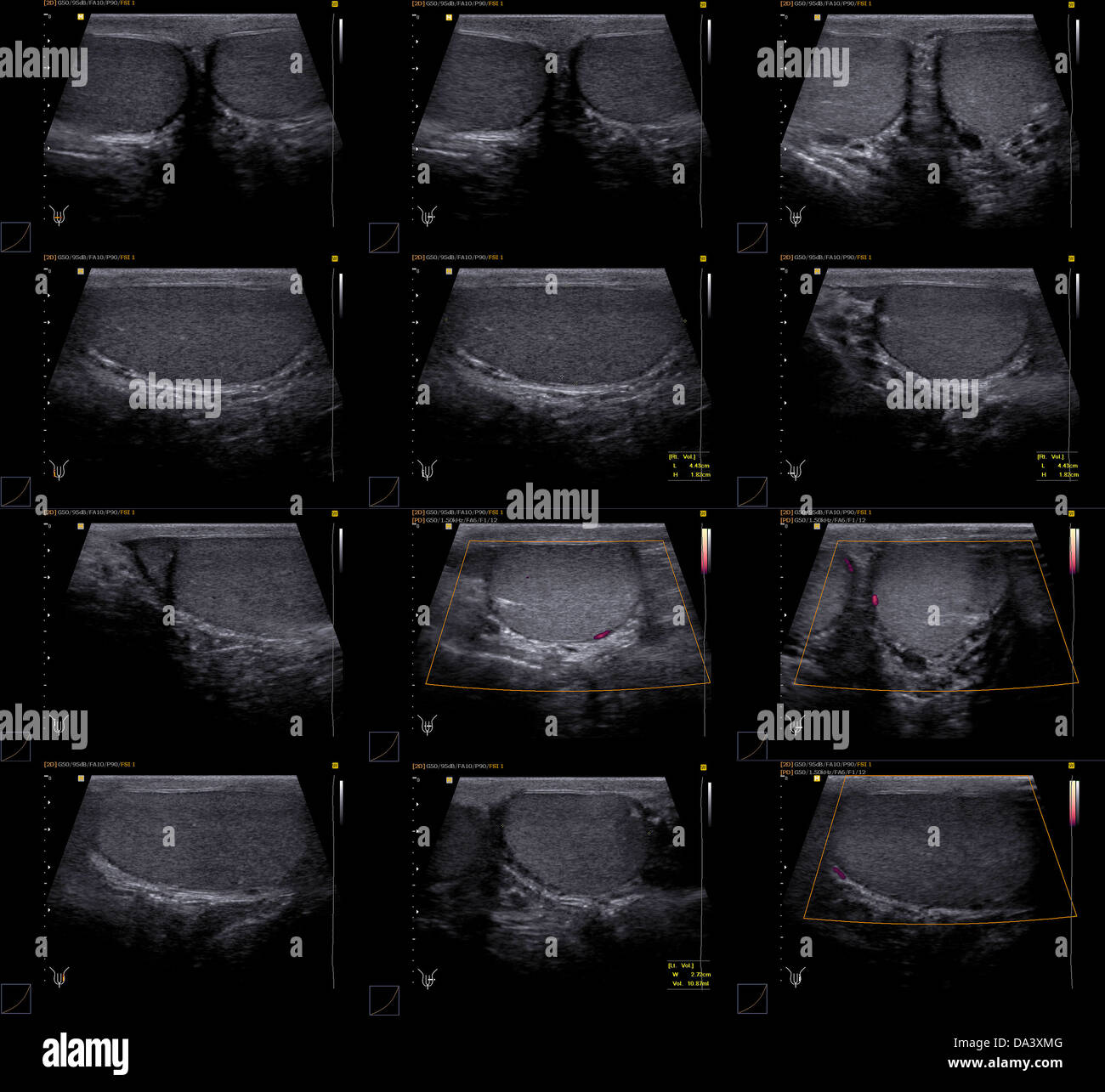 Ecografia scrotale immagini e fotografie stock ad alta risoluzione - Alamy