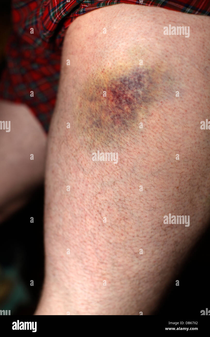 Livido doloroso immagini e fotografie stock ad alta risoluzione - Alamy