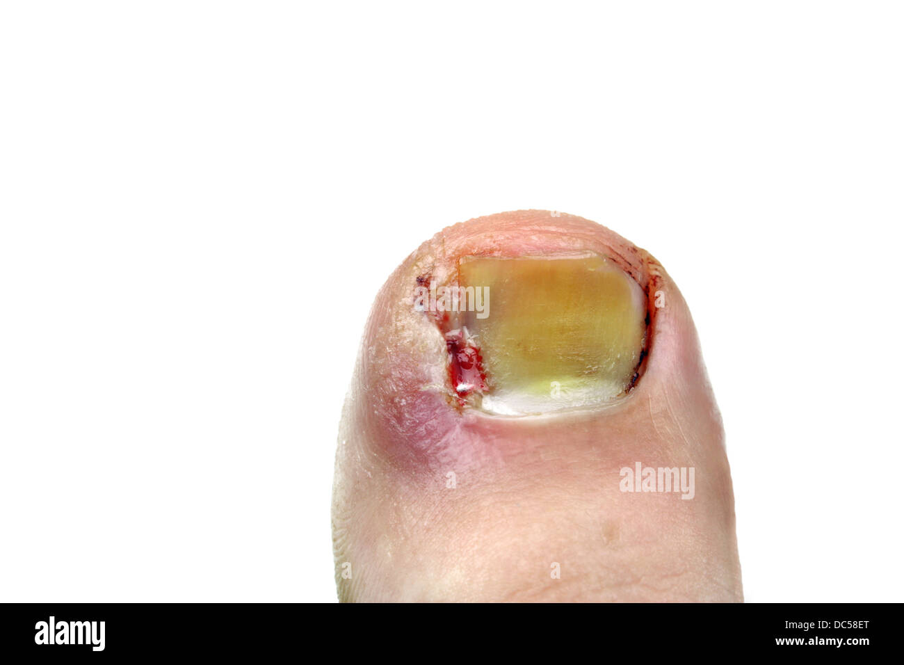 Unghia incarnita immagini e fotografie stock ad alta risoluzione - Alamy