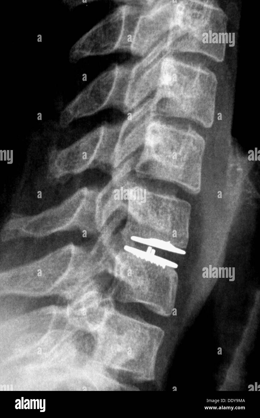 Vertebra cervicale colonna cervicale immagini e fotografie stock ad ...
