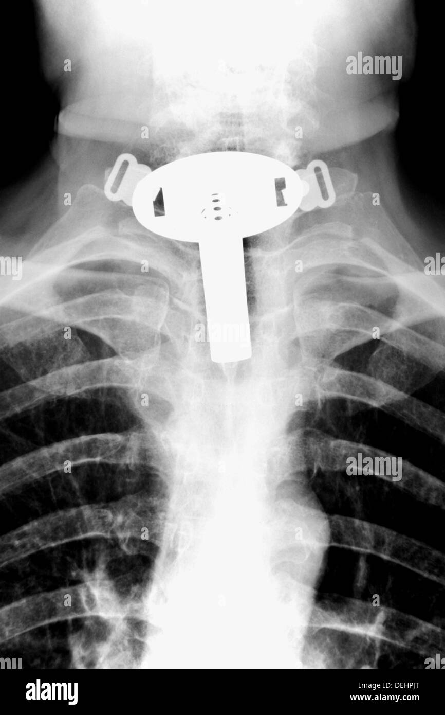 Tracheotomia tracheotomia immagini e fotografie stock ad alta ...