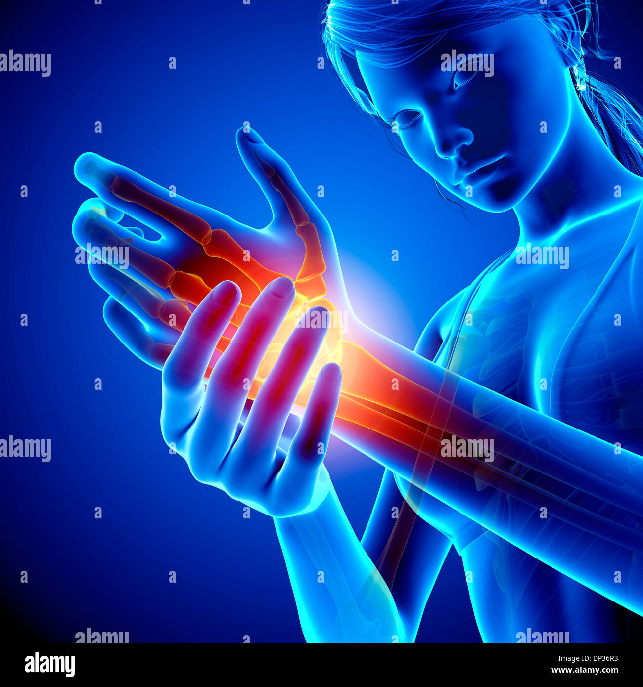 Polso tendinite immagini e fotografie stock ad alta risoluzione - Alamy